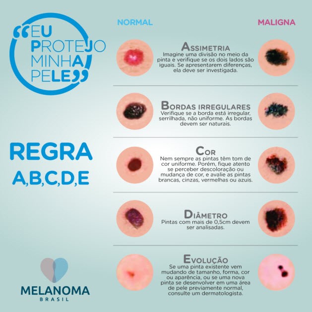 melanoma cutâneo | O seu portal de beleza na web | Beleza Today melanoma cutâneo | O seu portal de beleza na web | Beleza Today