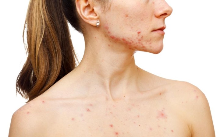 Conheça os tipos de acne e seus tratamentos | O seu portal de beleza na ... Conheça os tipos de acne e seus tratamentos | O seu portal de beleza na ...